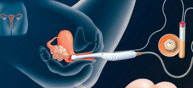 Egg Collection for IVF in Chennai | Genesis Fertility Center